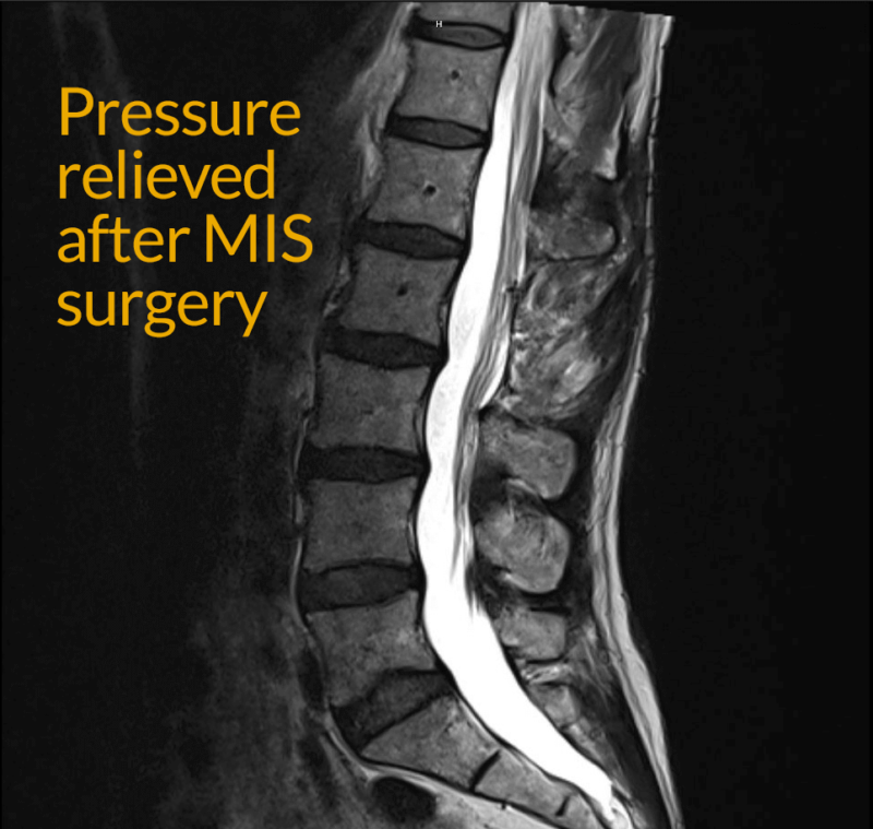 Minimally Invasive Procedures for Decompression of the Spine