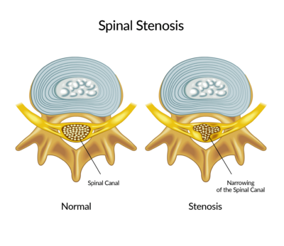 Spinal Stenosis: Types, Causes, Symptoms, and Treatment Options